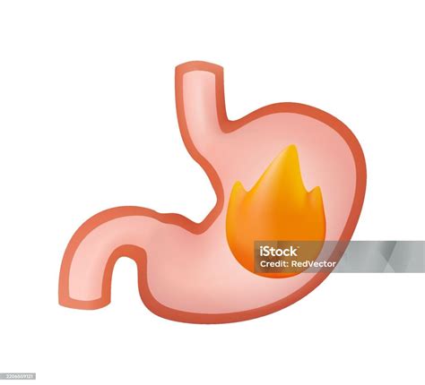 인간의 위 역류 그림 위산 역류 가스 형성 박테리아 위 치유 궤양 위염 위식도 질환 또는 속쓰림 증상 위장관 계통 질환 3차원 형태에 대한 스톡 벡터 아트 및 기타 이미지