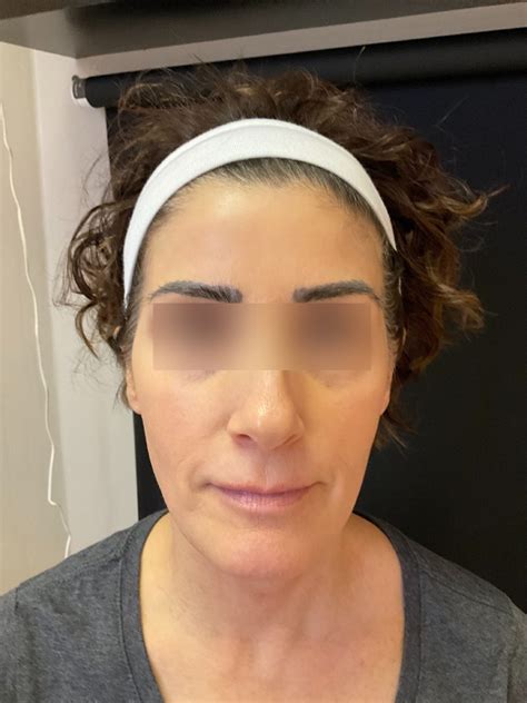 Prp Injections Before And Afters In Leawood Dr Quinn