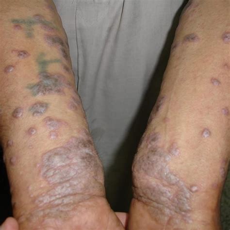 Lichen Planus Causes Symptoms And Treatments Dr Health Clinic