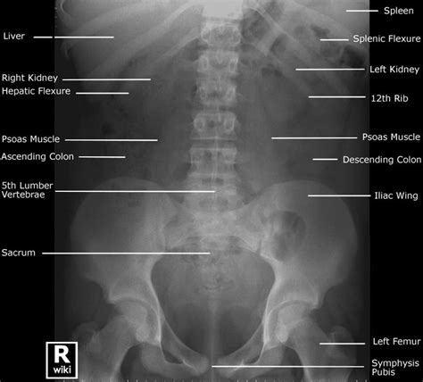 Best Images About XRAY On Pinterest Bone And Joint Radiology And Scapula