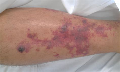 Purpura Fulminans Avis Purpura Fulminans Définition Et Traitements