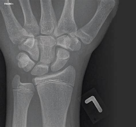 Scaphoid Fracture After A Fall Archives Journal Of Urgent Care Medicine