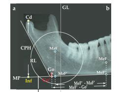 Gonial Angle European Journal Of Anatomy