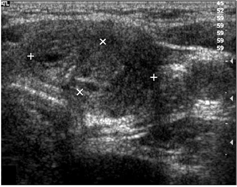 Figure 2 From A Case Of Riedels Thyroiditis Associated With A Benign Nodule Semantic Scholar