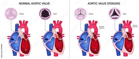 The Difference Of Normal Aortic Valve And Aortic Valve Stenosis