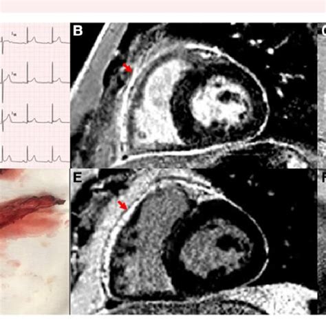 Cardiac Investigations Demonstrating Pericarditis A An Ecg Download Scientific Diagram