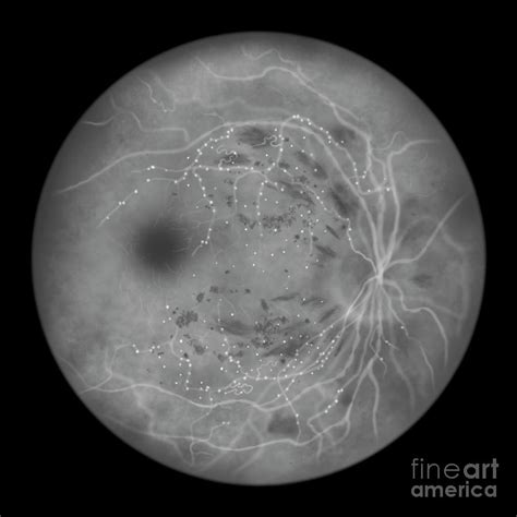Retina Damage From Diabetes 95 Photograph By Kateryna Konscience