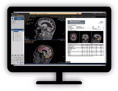 Philips Mr Neuroquant Automated Brain Image Analysis