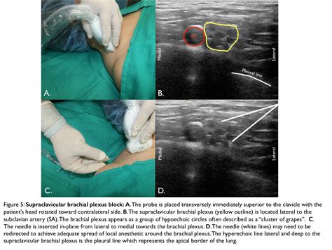 Supraclavicular Block