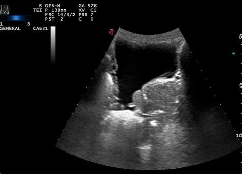Radiopaedia Case Multiple Bladder Diverticula Id 30578 Study 31237
