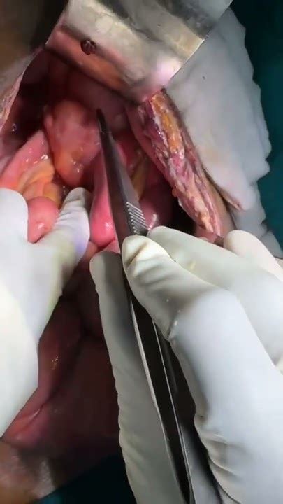 Re Do Exploratory Laprotomy For Abdominal Sepsis Youtube
