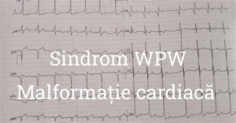 Wpw Sindrom Wolff Parkinson White Wpw ‣ Clinica Speranța Craiova