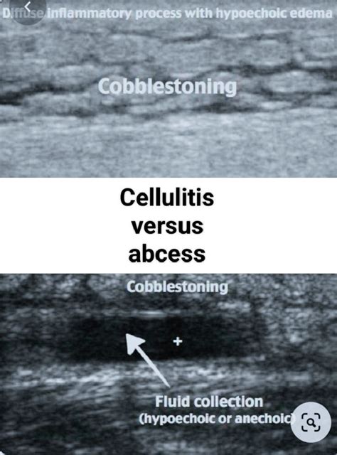 Radiology On Ultrasound Cellulitis And An Abscess Can Appear Similar