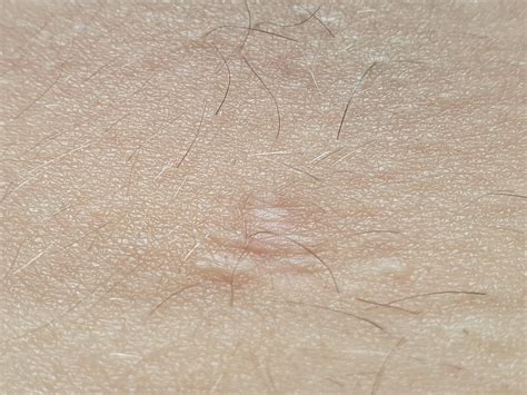 Nsfw Scars I Wanted To Show How Good My Scars Look The One Year Anniversary Of My Lap Was Was