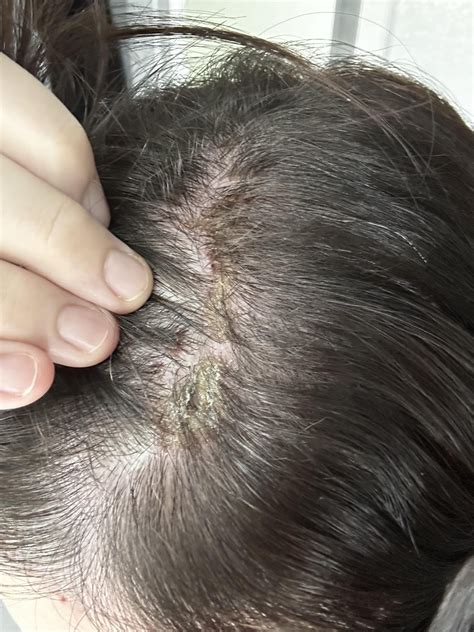 Picking Scalp Causing Scabs Need Help Rcalmhands Picking Scalp Causing Scabs Need Help Rcalmhands