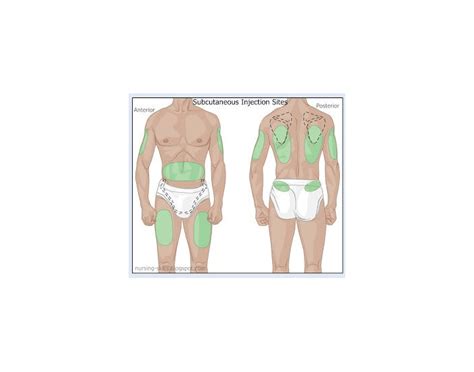 Subcutaneous Injection Sites Quiz