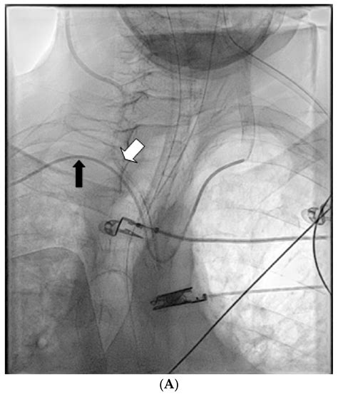 Management Of Inadvertent Arterial Catheterization During Central