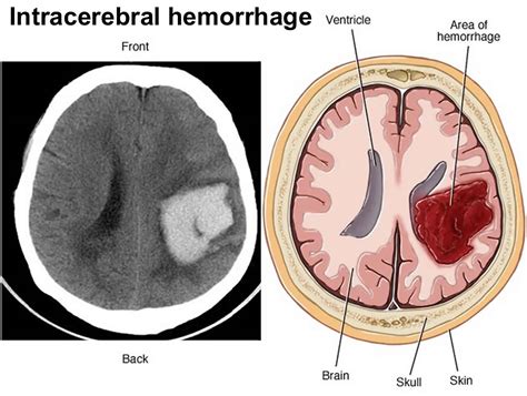 Intracerebral Hemorrhage Causes Symptoms Diagnosis Treatment And Recovery