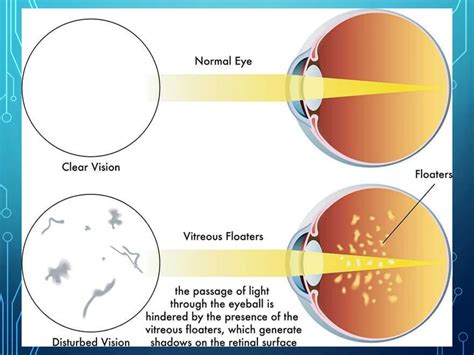 Myopia Basics Causes Types And Treatment Pptx