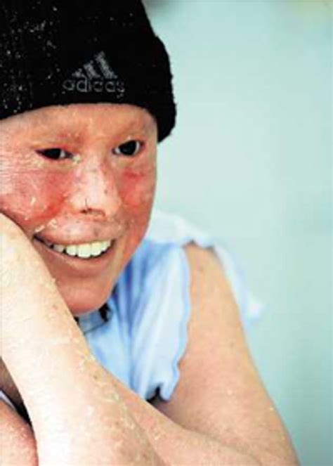 Harlequin Ichthyosis Survivor