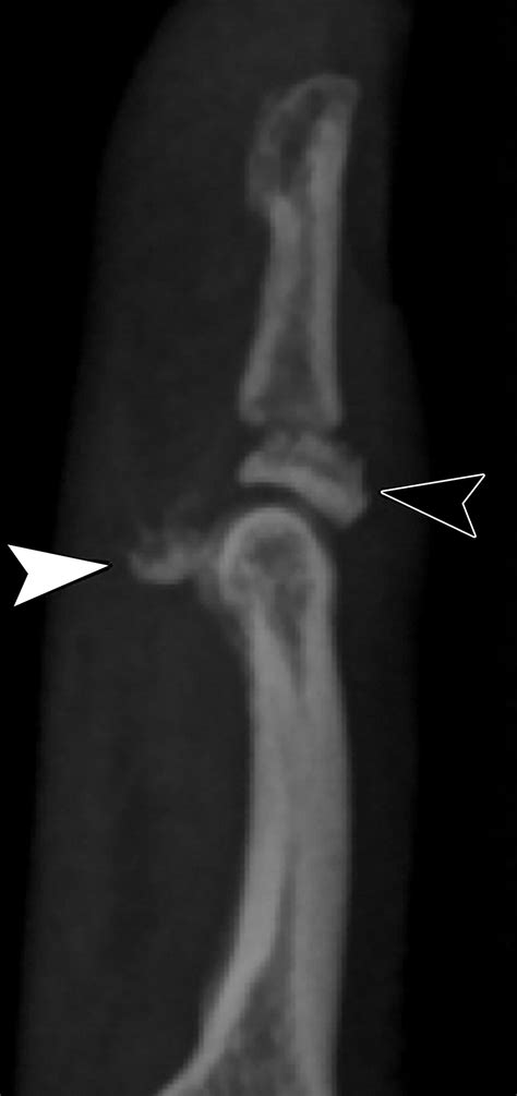 Avulsion Injuries Of The Hand And Wristradiographics