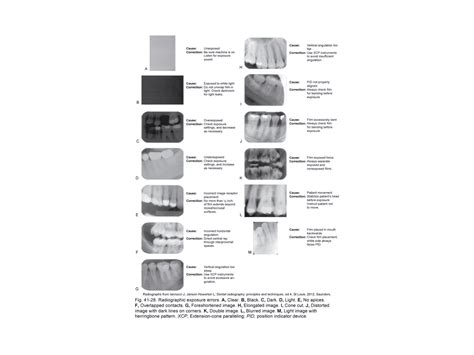 Radiographic In Dental Radiography Errors