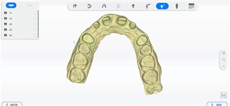 Model Modification Intraoralscan