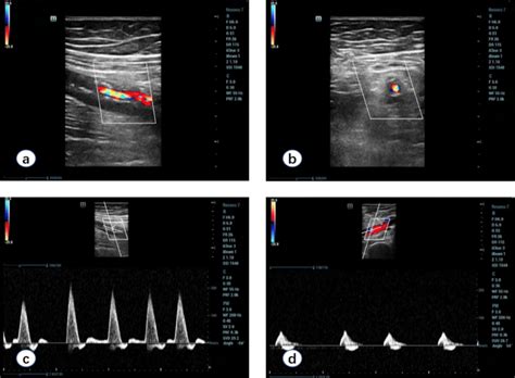 4 A A Longitudinal Color Doppler Image Of A Mid To Distal Left