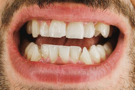 How Diet And Oral Hygiene Reduce Cracked Teeth Risk