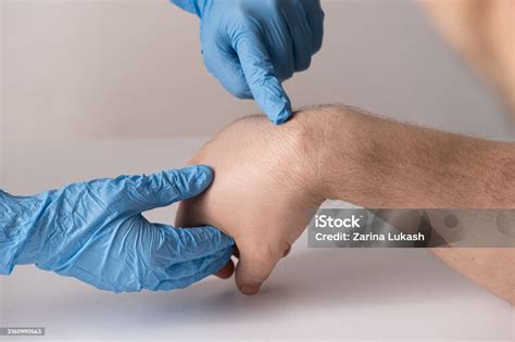 남성 환자의 손에 있는 손목의 신경절 낭종 또는 습도종 의사의 검사 낭포에 대한 스톡 사진 및 기타 이미지 낭포 2명