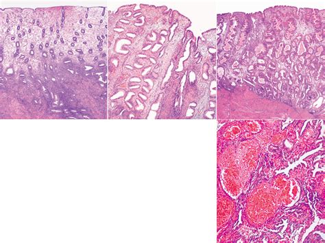 Proliferative Endometrium Histology