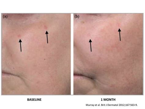 Skin Manifestations Of Scleroderma By Dr Lorinda Chung Md Pptx