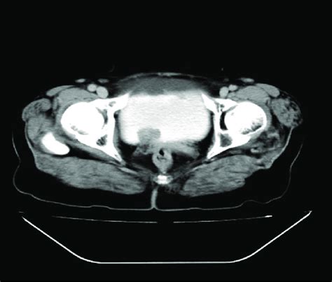 Contrast Enhanced Ct Showing Lesion Arising From Posterior Wall Of