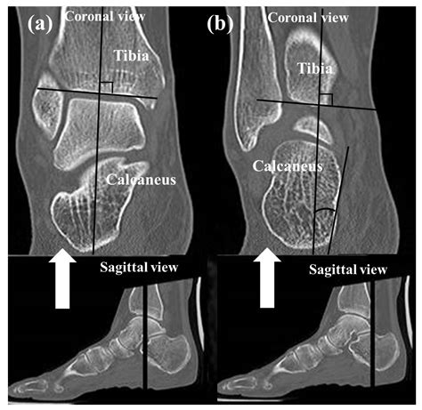 Weightbearing Computed Tomography Wbct Analysis Of Subtalar Joint