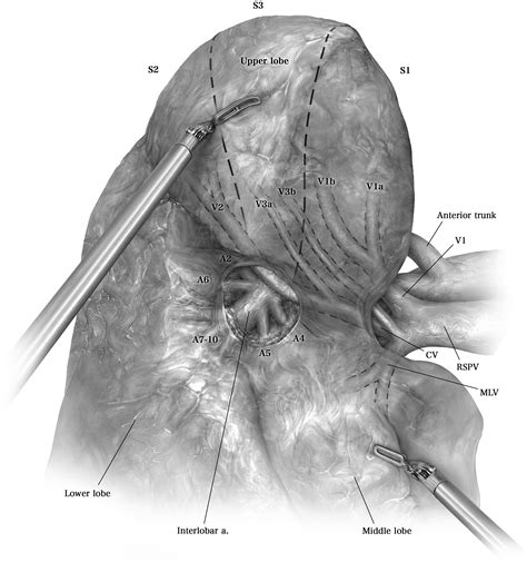 Minimally Invasive Complex Segmentectomies Of The Right Upper Lobe Anterior Segmentectomy