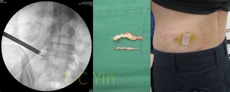 脊椎手術 鄞宗誠醫師 Tsung Cheng Yin Md 微創脊椎內視鏡手術 1 疼痛五個月無法治癒的怪手司機