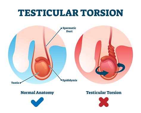 What Is Testicular Torsion