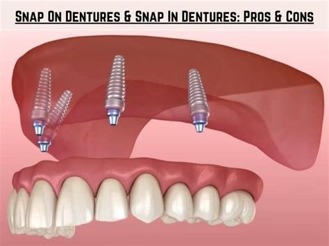 Snap On Dentures And Snap In Dentures Pros And Cons
