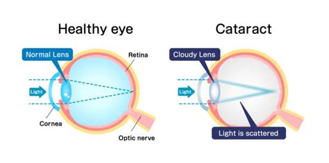 280 Ciliary Process Ilustrasi Grafik Vektor And Clip Art Bebas Royalti