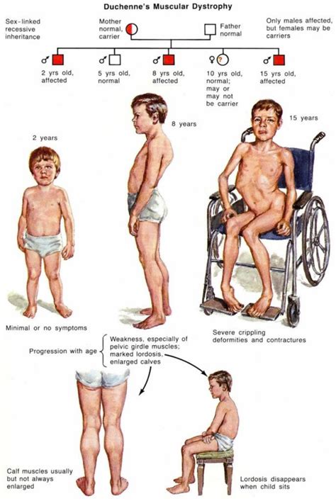 Anjali Understanding Duchenne Muscular Dystrophy Dmd Duchenne