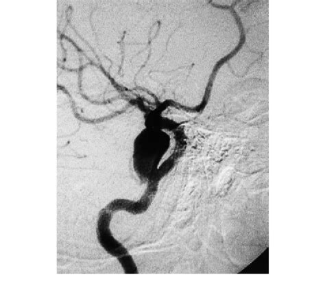 Right Internal Carotid Angiogram Oblique View Demonstrating The