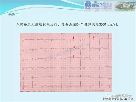 肺栓塞心电图表现及鉴别诊断 搜狐大视野 搜狐新闻