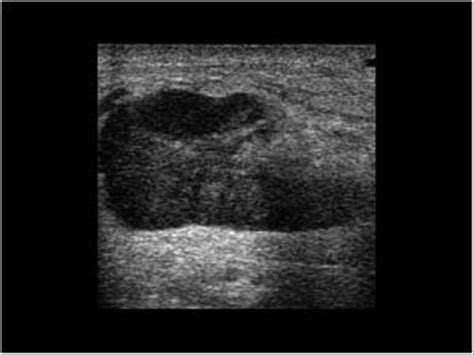 Musculoskeletal Joints And Tendons 62 Elbow Case 626 Tumors And