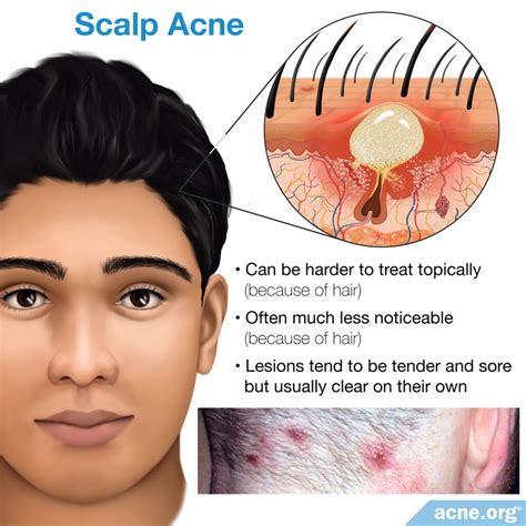 Why Do I Suddenly Have Pimples On My Scalp At Megan Cisneros Blog