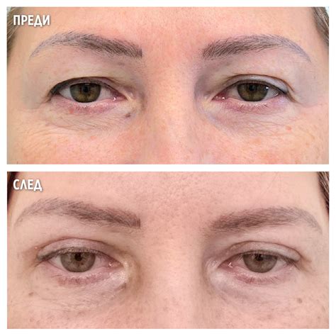 Снимки преди и след