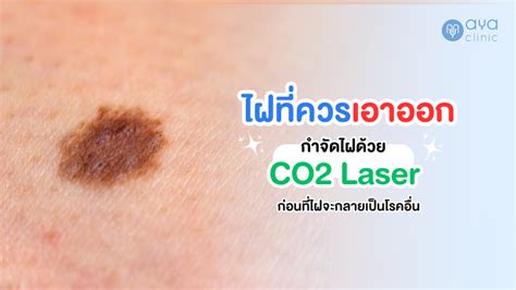ไฝที่ควรเอาออก ไฝแบบไหนที่อันตราย กำจัดไฝด้วยco2 Laser