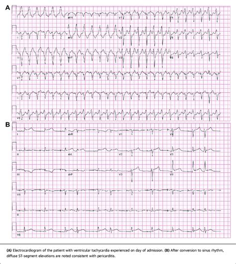 Electrocardiograms During Initial Presentation Download Scientific Diagram