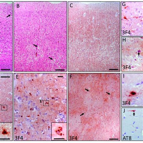 Neuropathological Findings A Frontal Cortex Hande Prominent Download Scientific Diagram