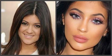 Кайли Дженнер до и после пластики настоящие фото