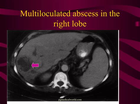Management Of Liver Abscess Ppt